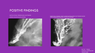 Ductography by prof j venkat | PDF