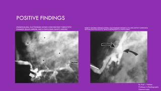 Ductography by prof j venkat | PDF