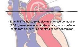 Ductus arterioso | PPTX