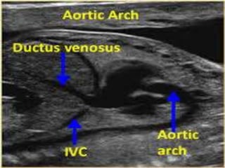 Ductus venosus | PPT