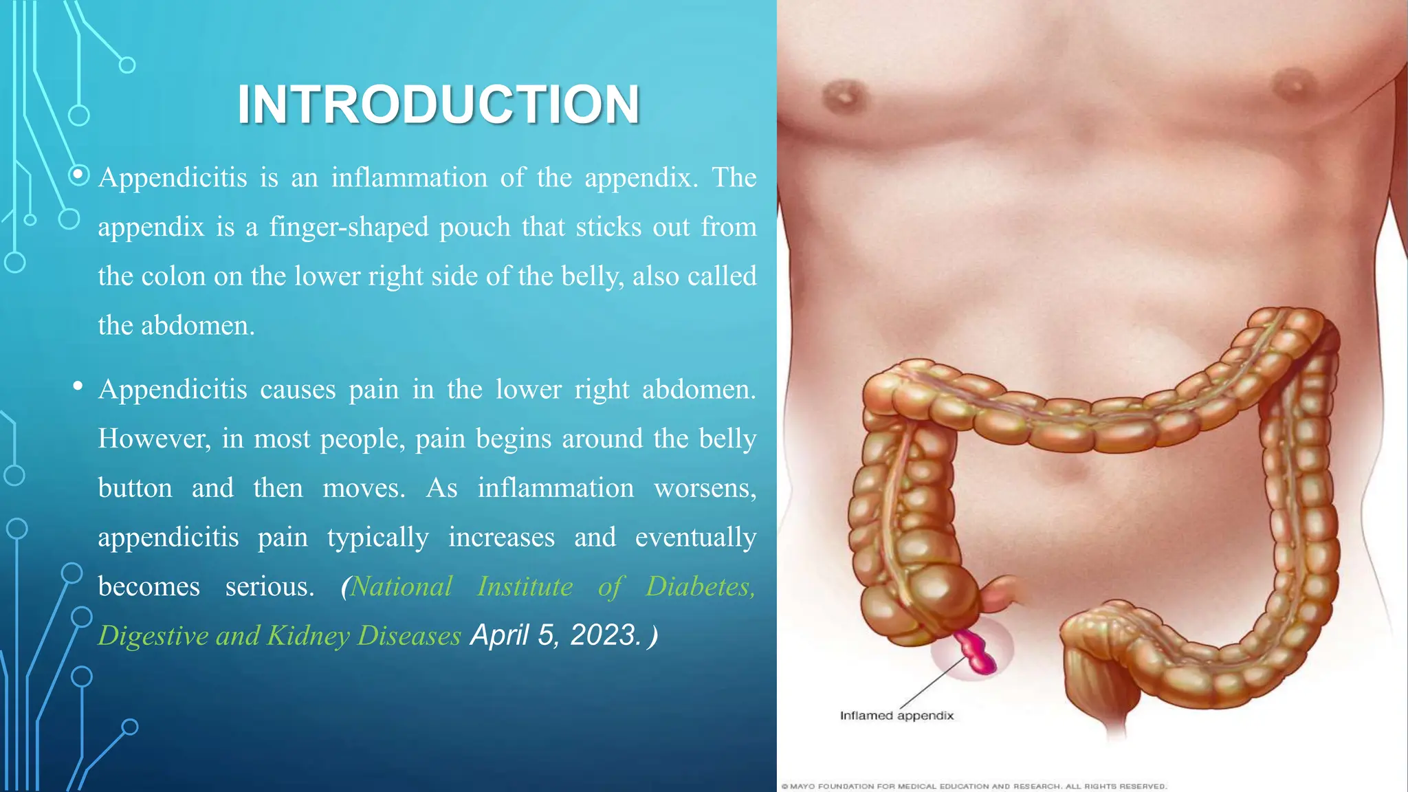 Seminar presentation on Appendicitis.pptx | Free Download