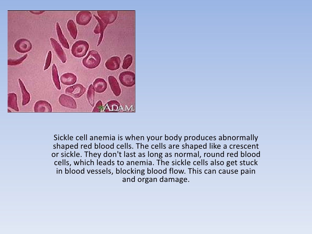 sickle-cell-anemia