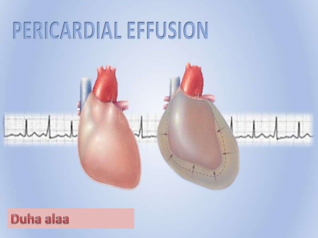 pericardial effusion | PPTX | Heart and Cardiovascular Diseases ...