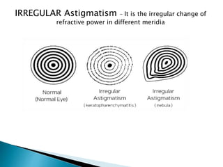 Astigmatism | PPTX