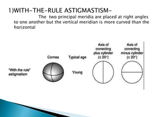 Astigmatism | PPTX