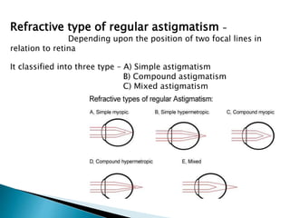 Astigmatism | PPTX