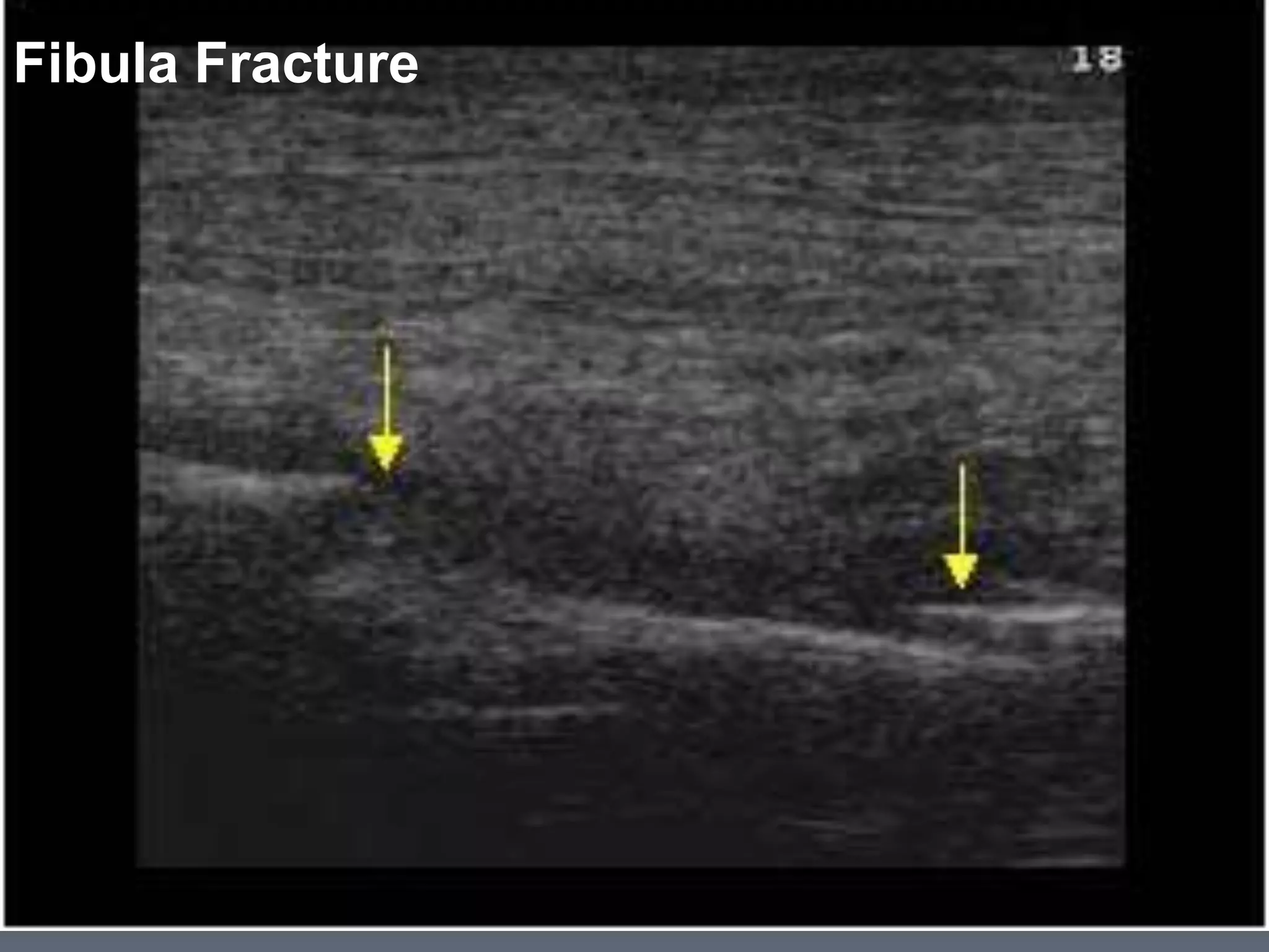 Enhancement Of Bone Fracture Image Using Filtering Techniques Ppt