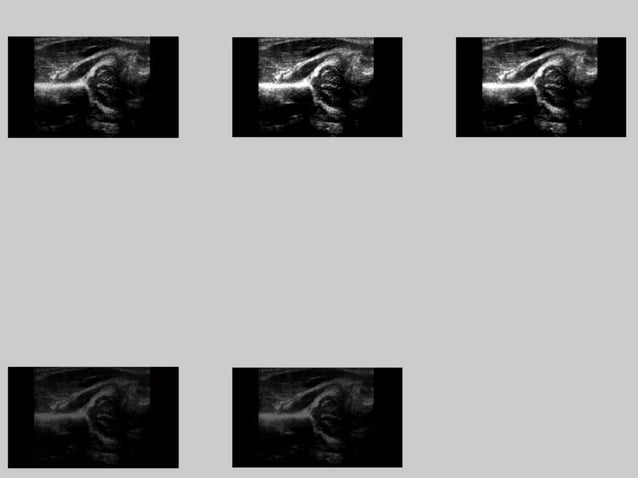 Enhancement Of Bone Fracture Image Using Filtering Techniques Ppt
