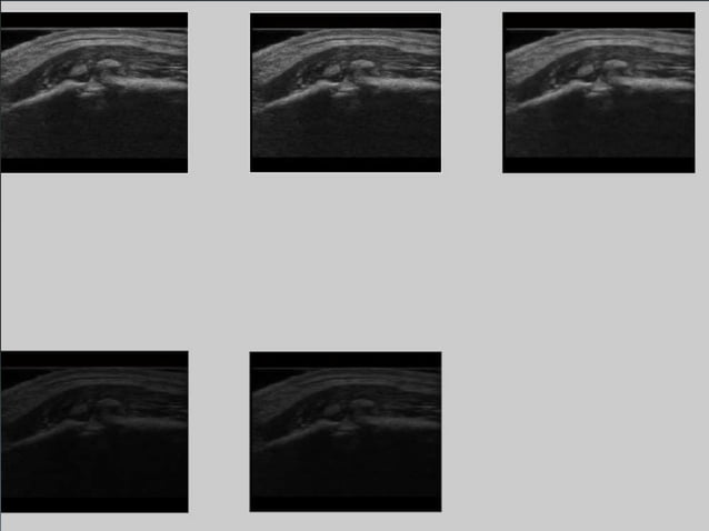 Enhancement Of Bone Fracture Image Using Filtering Techniques Ppt