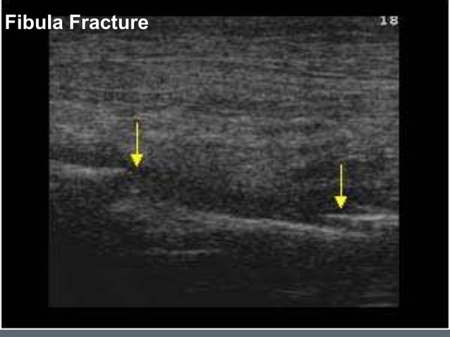 Enhancement of bone fracture image using filtering techniques | PPT