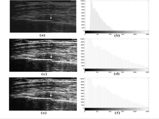 Enhancement of bone fracture image using filtering techniques | PPT