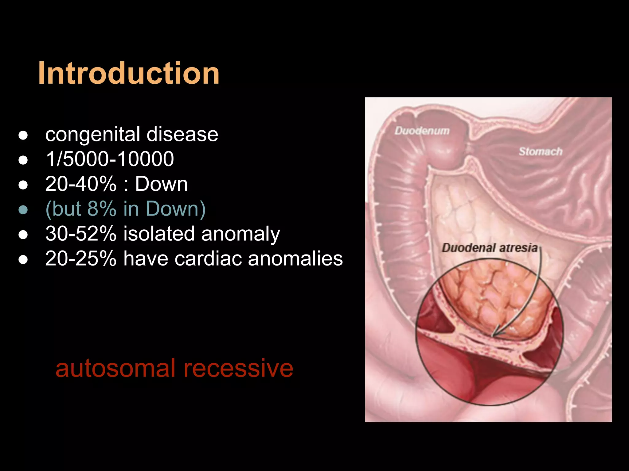 Duodenal Atresia Ppt