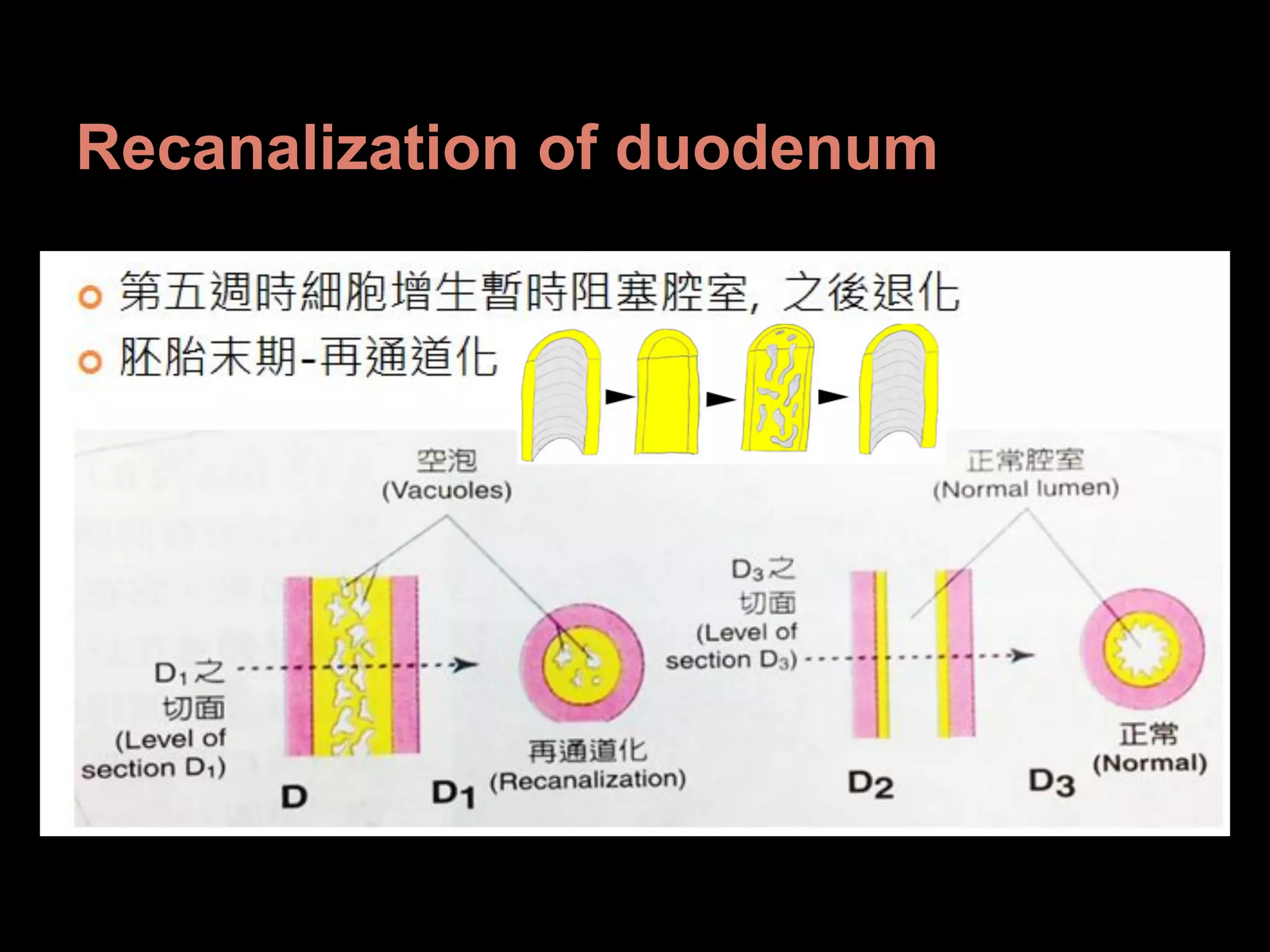 Duodenal atresia | PDF | Pregnancy | Reproductive Health