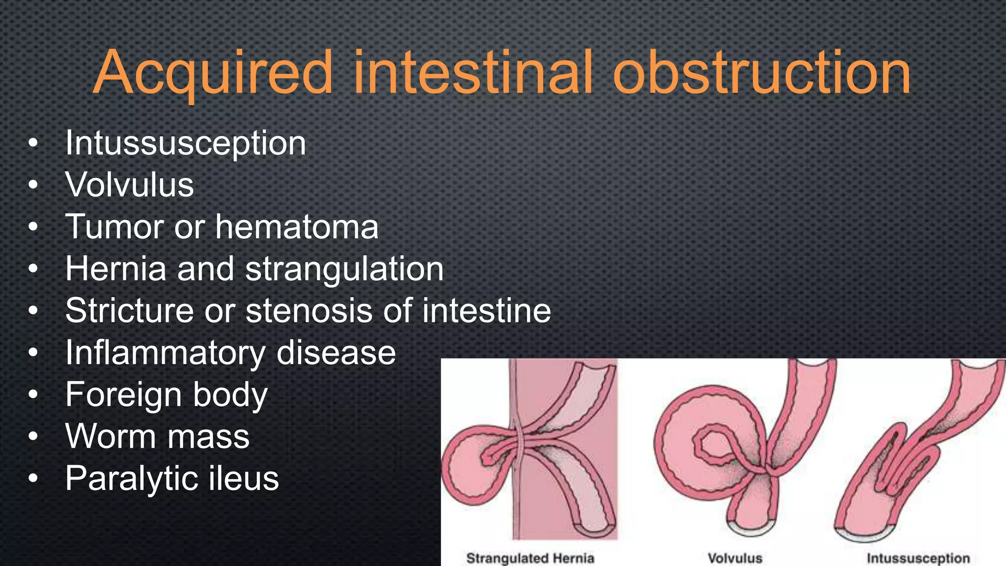 Duodenal atresia | PPTX