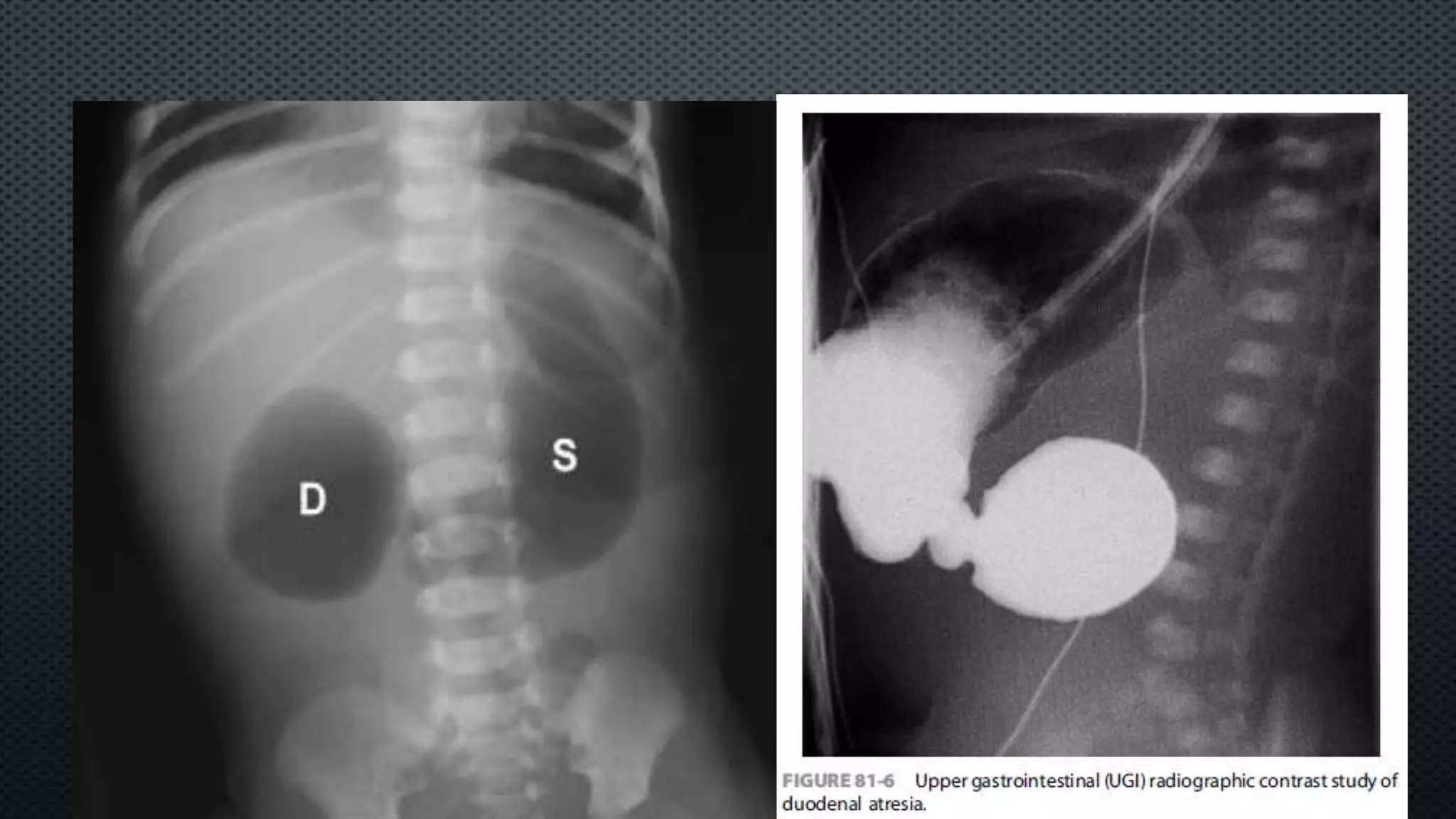 Duodenal atresia | PPTX