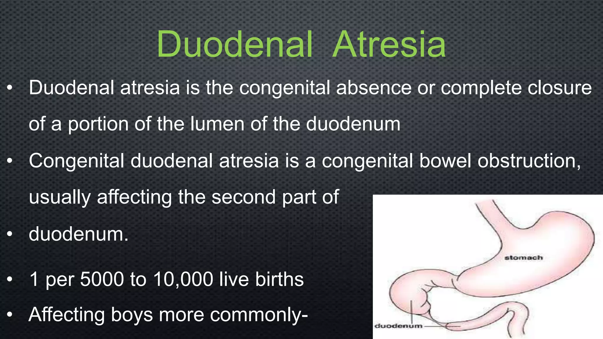 Duodenalatresia | PPTX