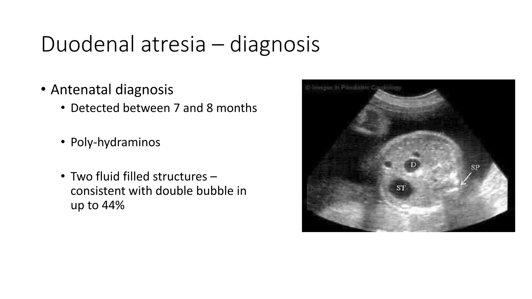 Duodenal atresia | PPTX