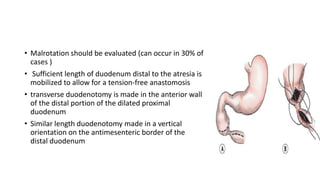 Duodenal atresia | PPTX
