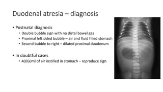 Double Bubble Duodenal Atresia