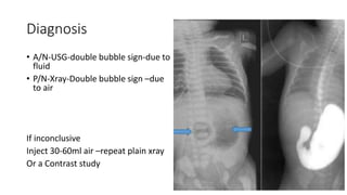 DUODENAL ATRESIA.pptx