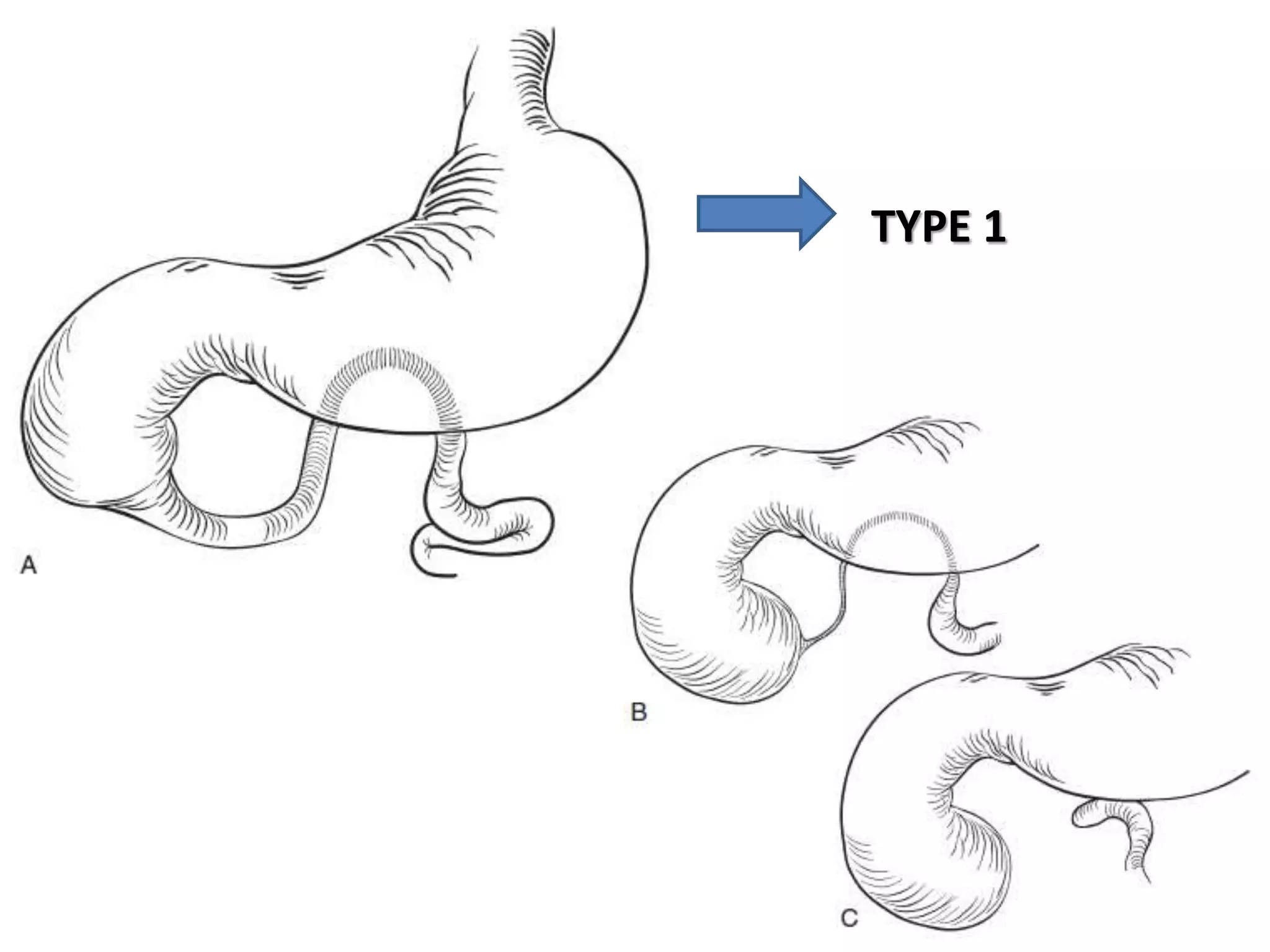 Duodenal atresia stenosis PRANAYA PPT | PPTX