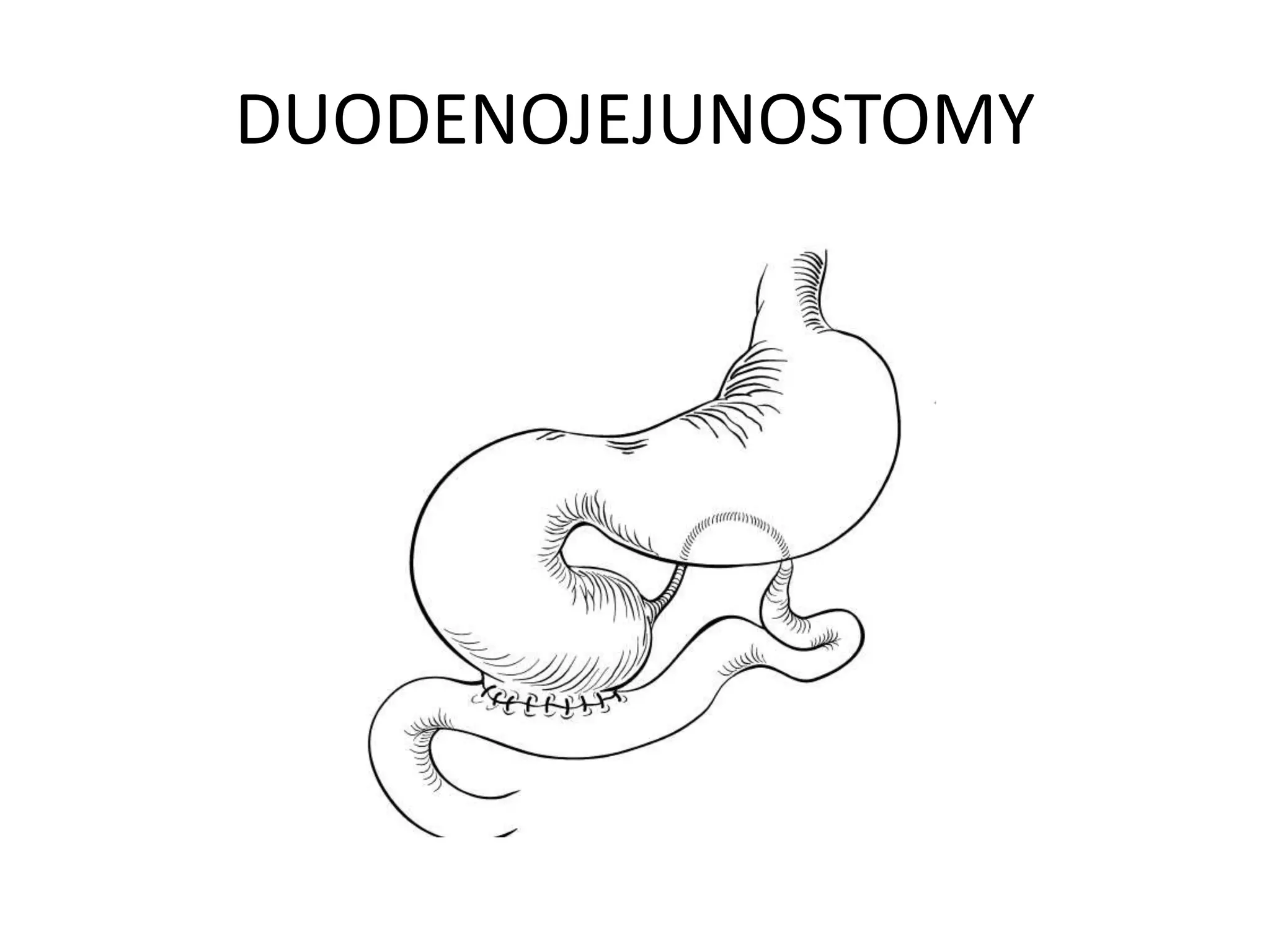 Duodenal atresia stenosis PRANAYA PPT | PPTX