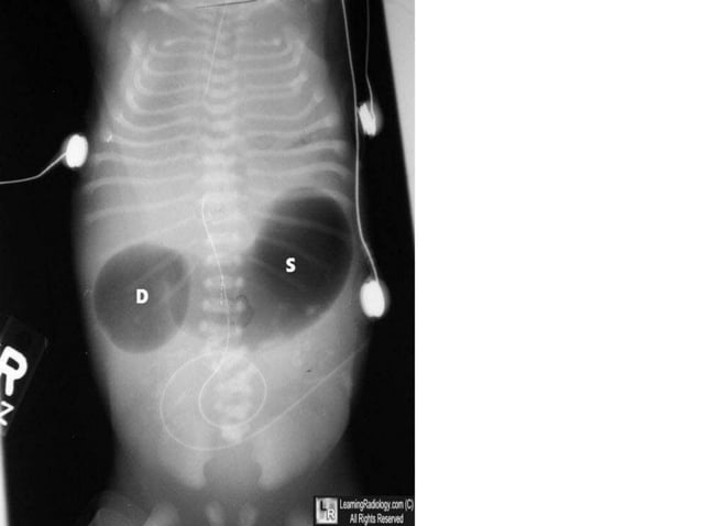 Duodenal atresia stenosis PRANAYA PPT | PPTX