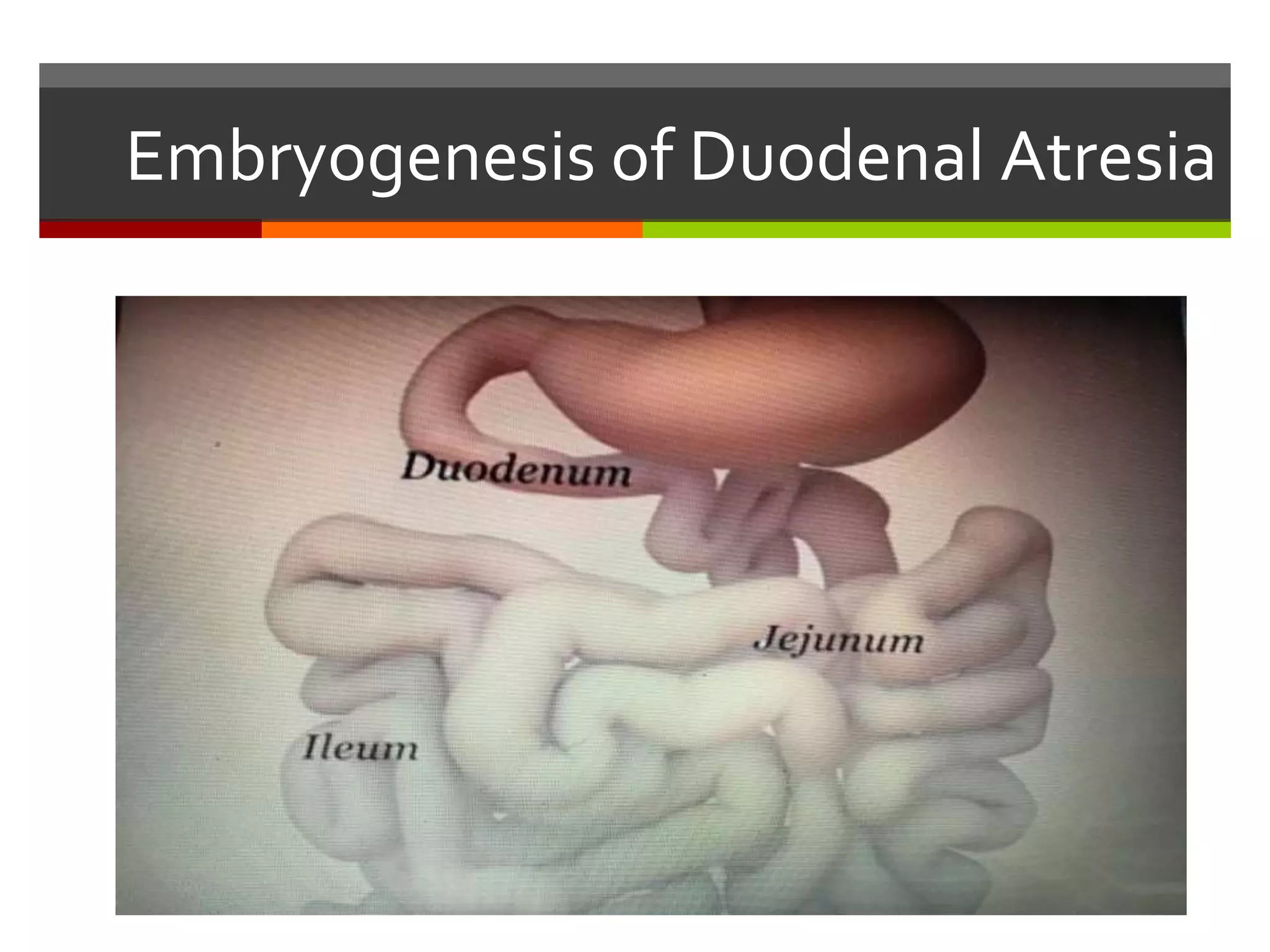 Duodenal atresia | PPT