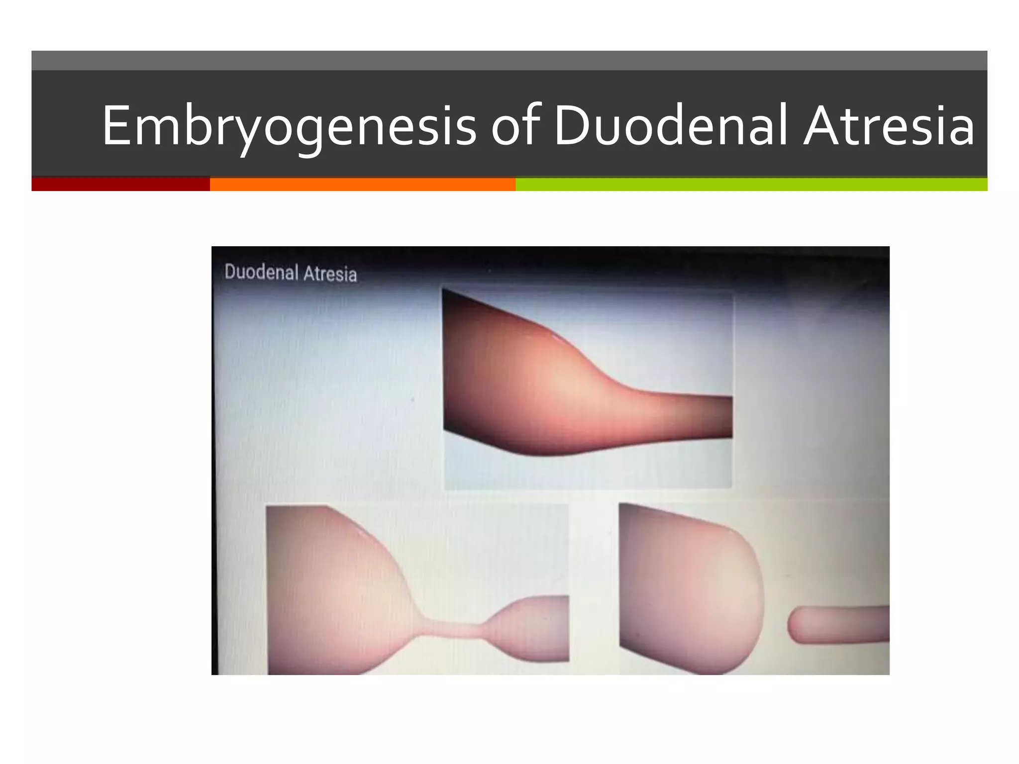 Duodenal atresia | PPT
