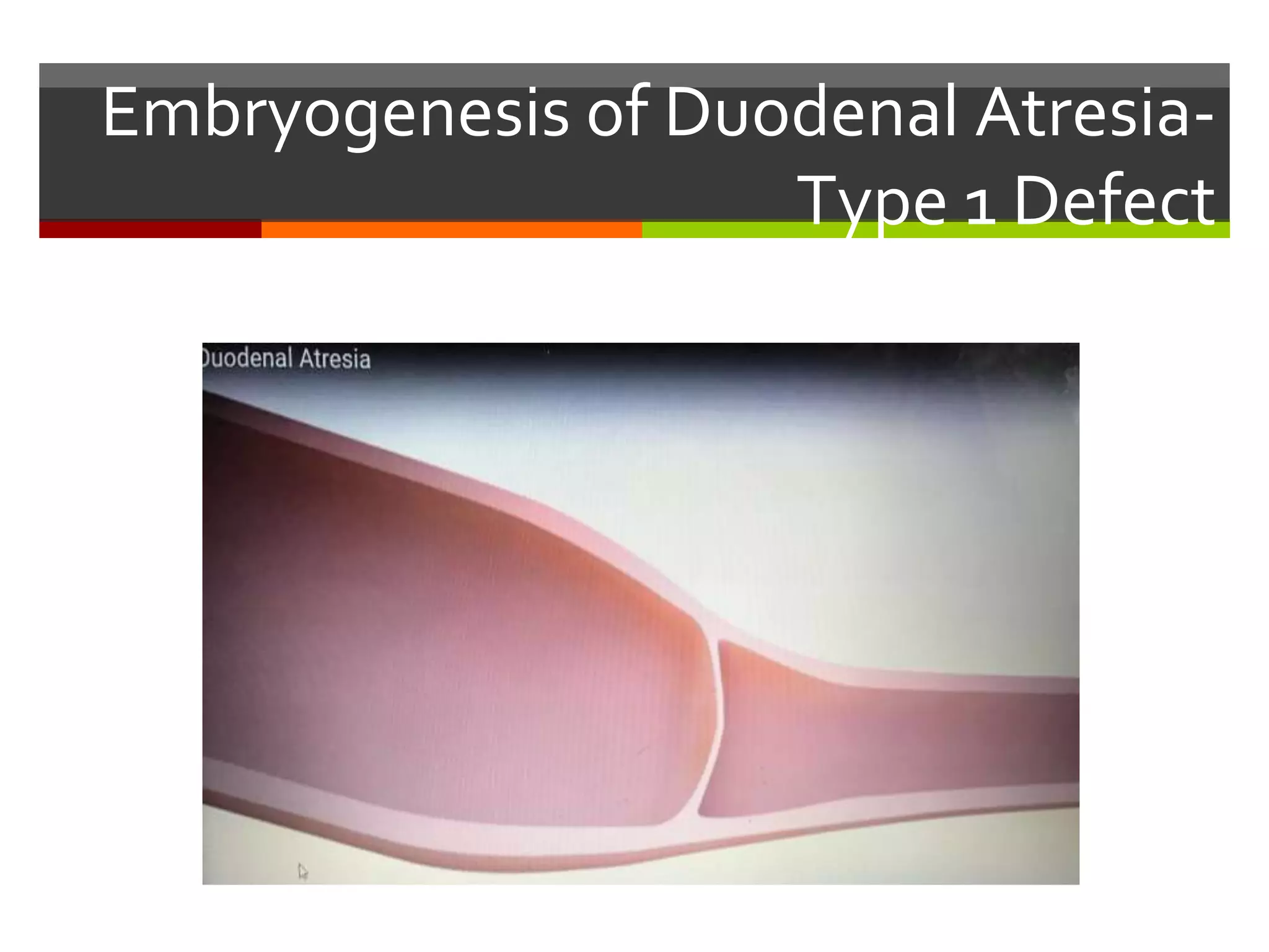 Duodenal atresia | PPT