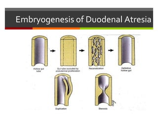 Duodenal atresia | PPT