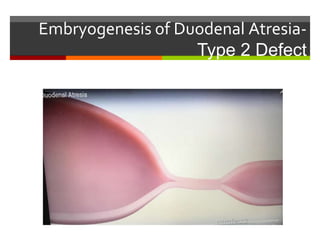 Duodenal atresia | PPT