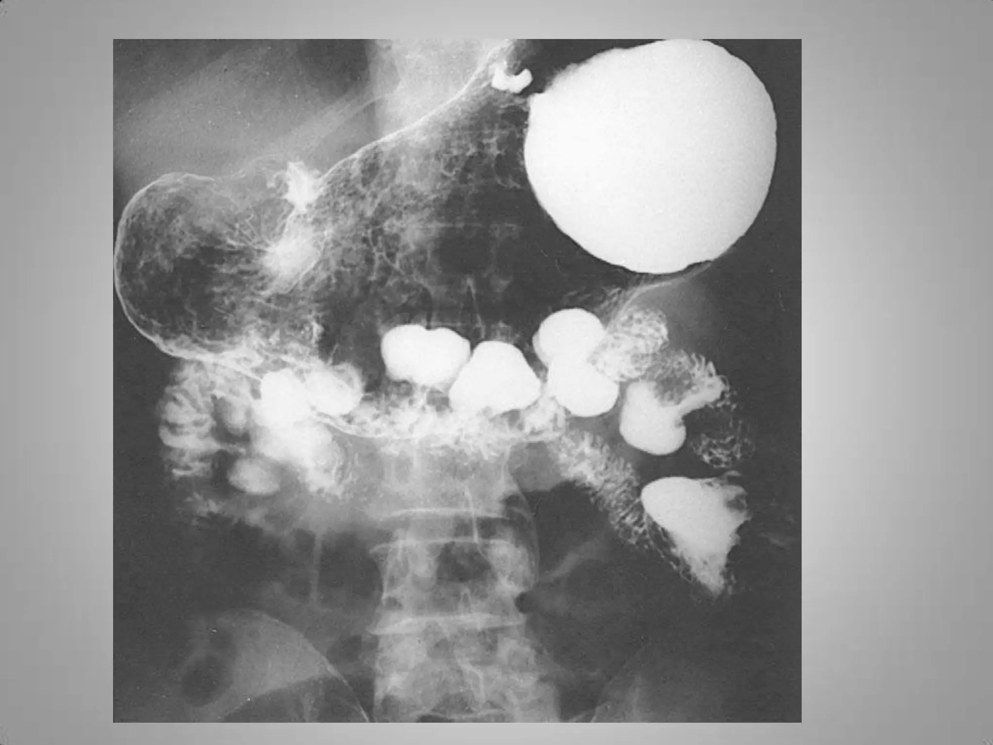 Duodenal diverticula | PPTX