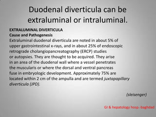 Duodenal diverticula | PPTX