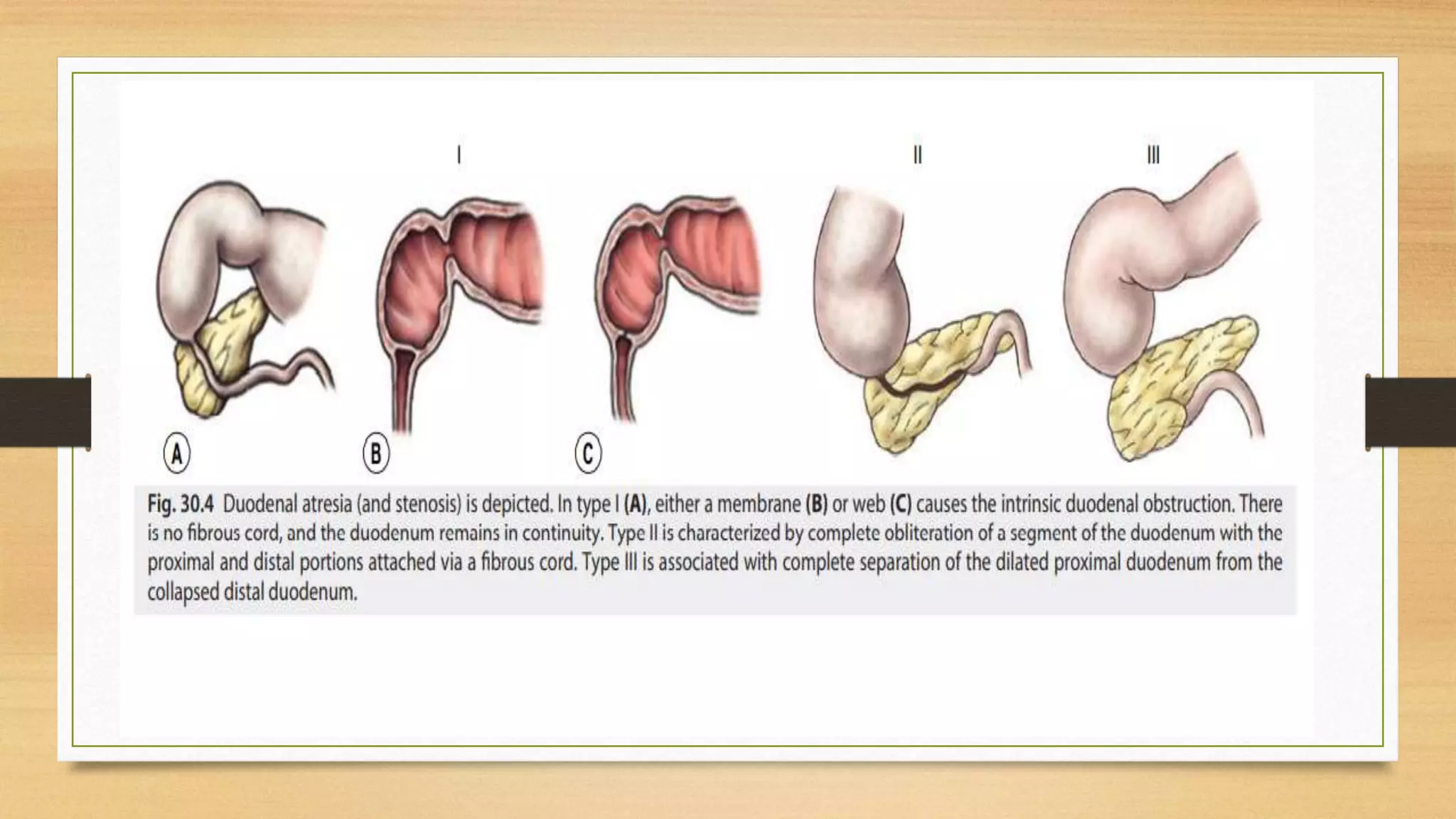Duodenal obstruction | PPTX