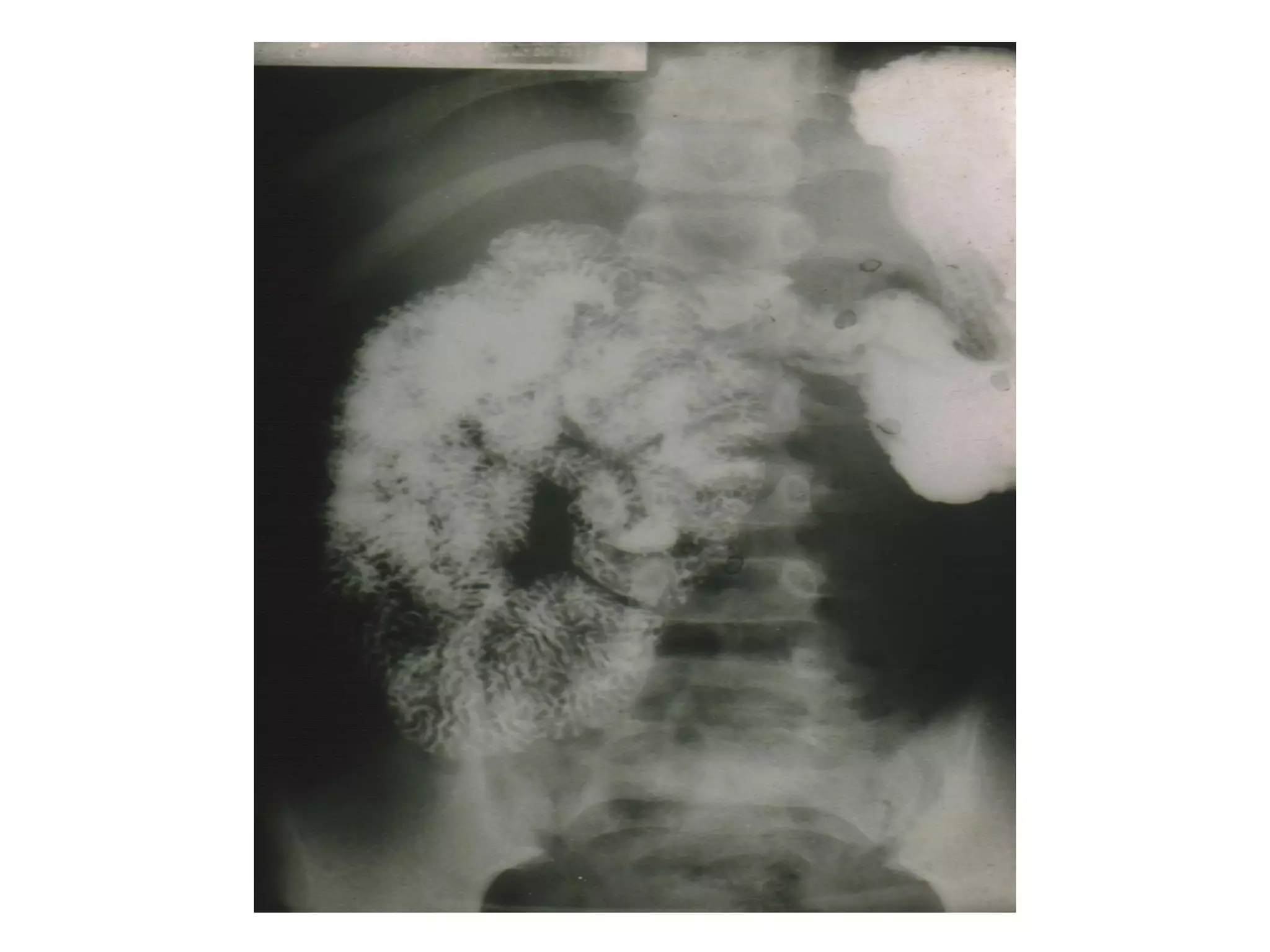 Duodenal obstruction (neonates) | PPT