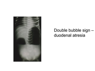 Duodenal obstruction (neonates) | PPT