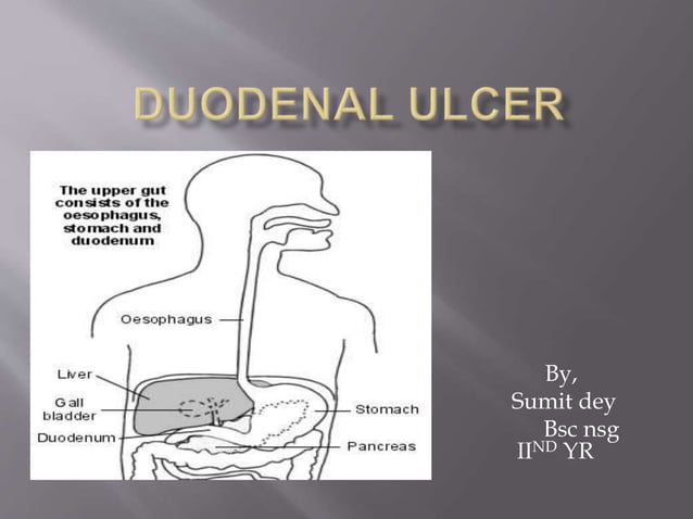 Duodenal ulcer presentation | PPTX