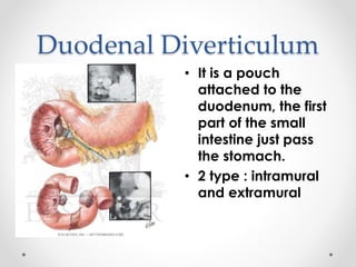 Duodenum and duodenal diverticulum | PPTX