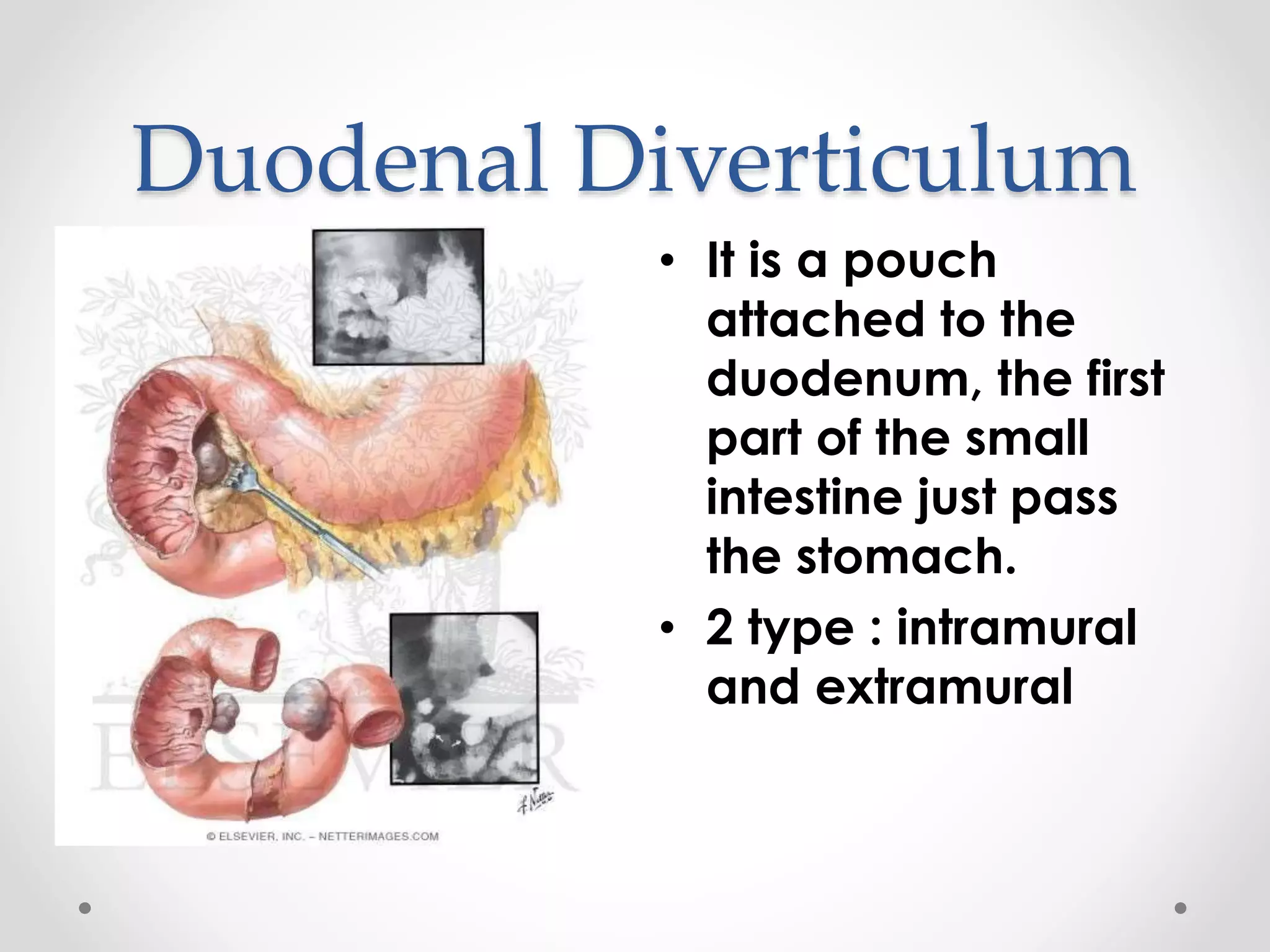 Duodenum and duodenal diverticulum | PPTX