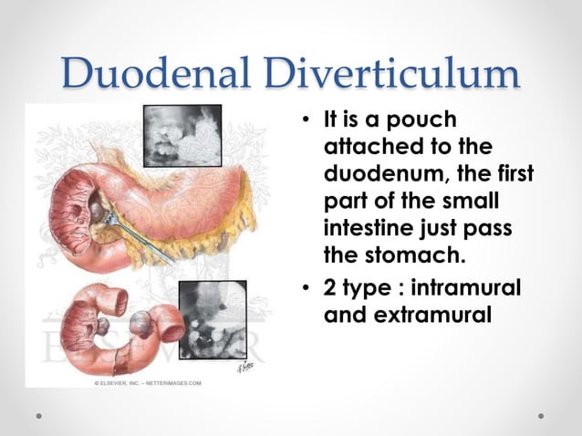 Duodenum and duodenal diverticulum | PPT