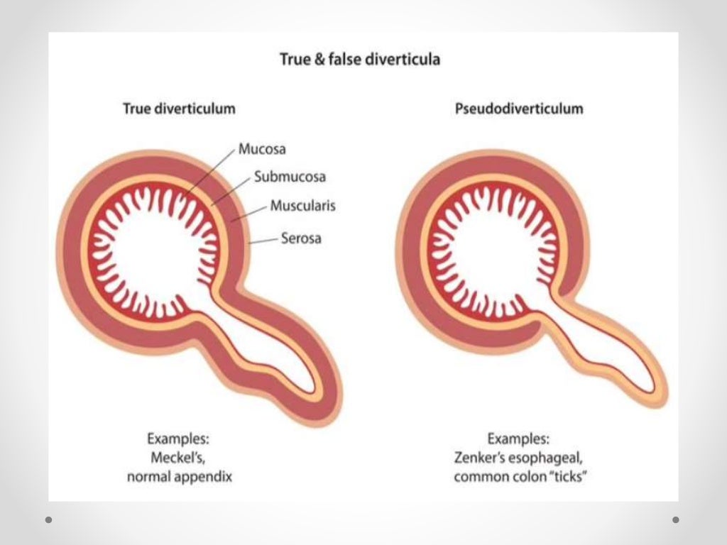 Duodenum and duodenal diverticulum