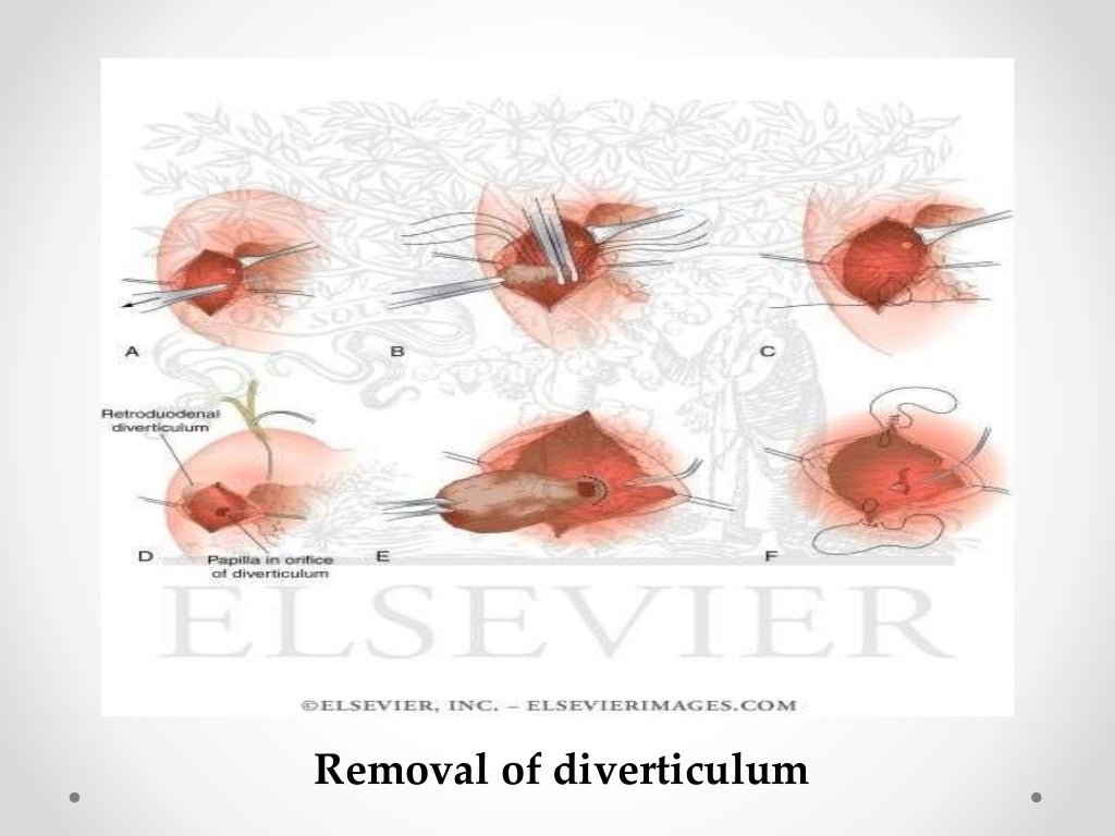 Duodenum and duodenal diverticulum