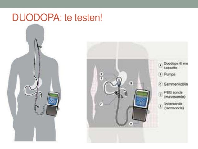 Duodopa - zegen en vloek - Dr. P. Bourgeois