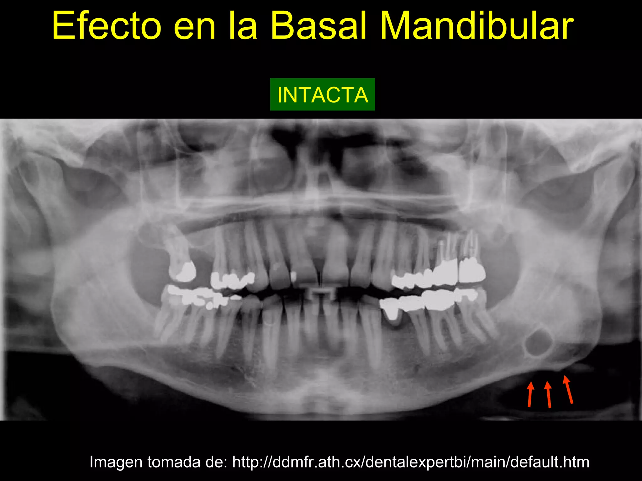 Defecto Oseo de Stafne | PDF