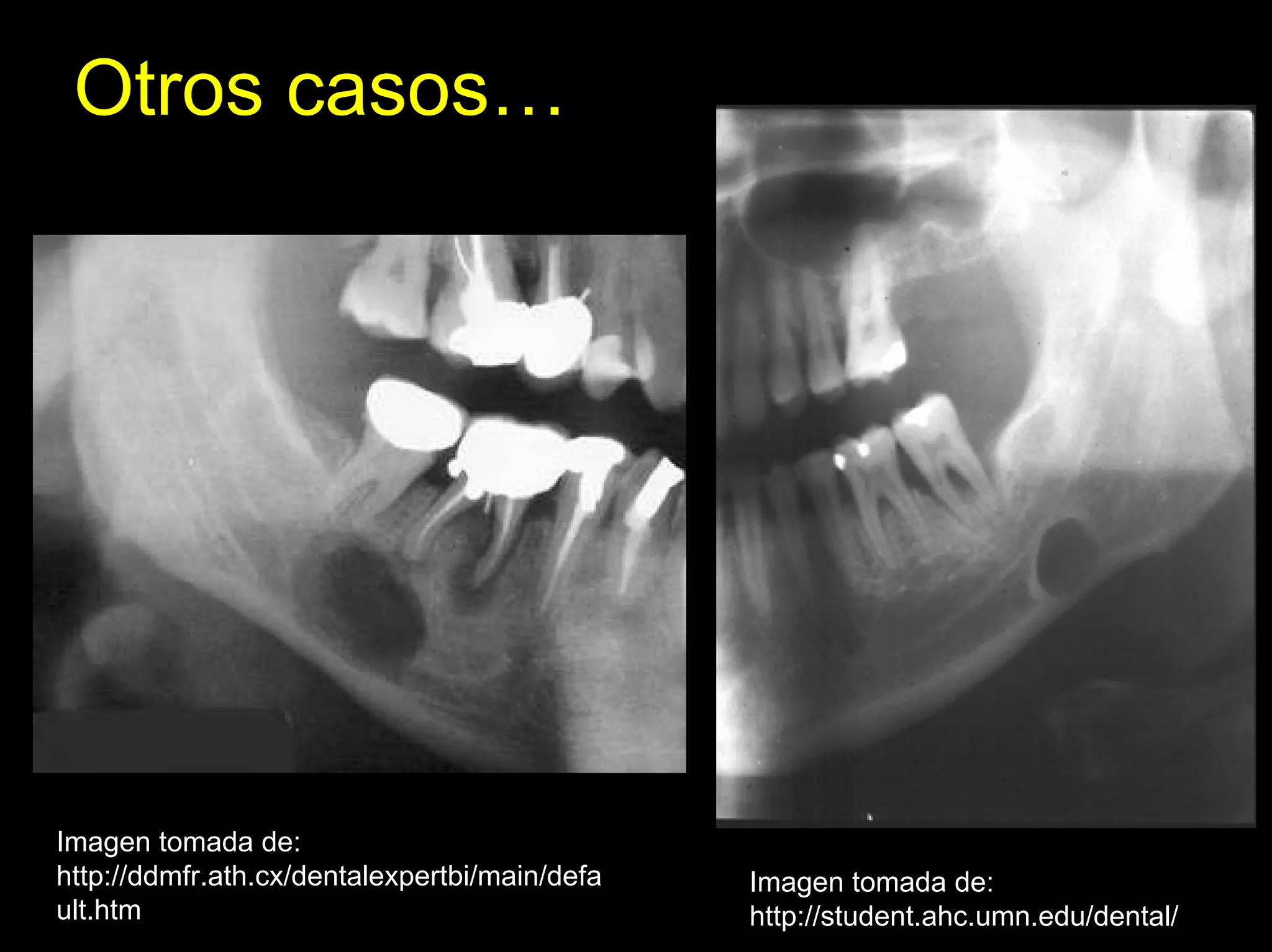 Defecto Oseo de Stafne | PDF