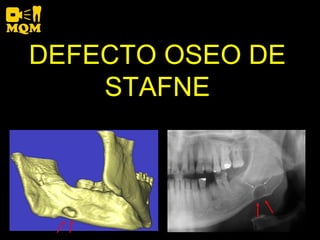 Defecto Oseo de Stafne | PPT