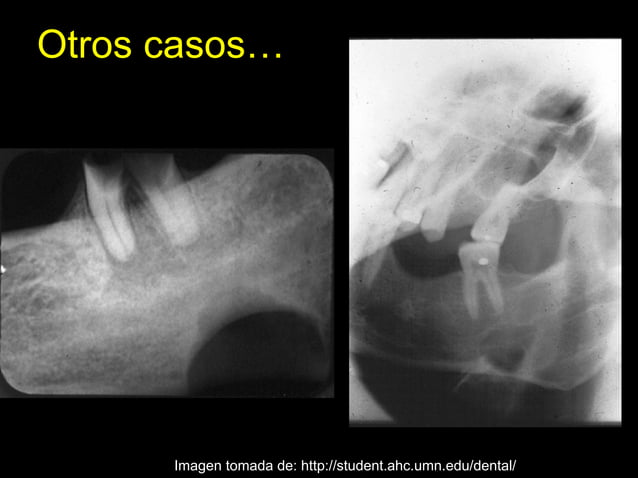 Defecto Oseo de Stafne