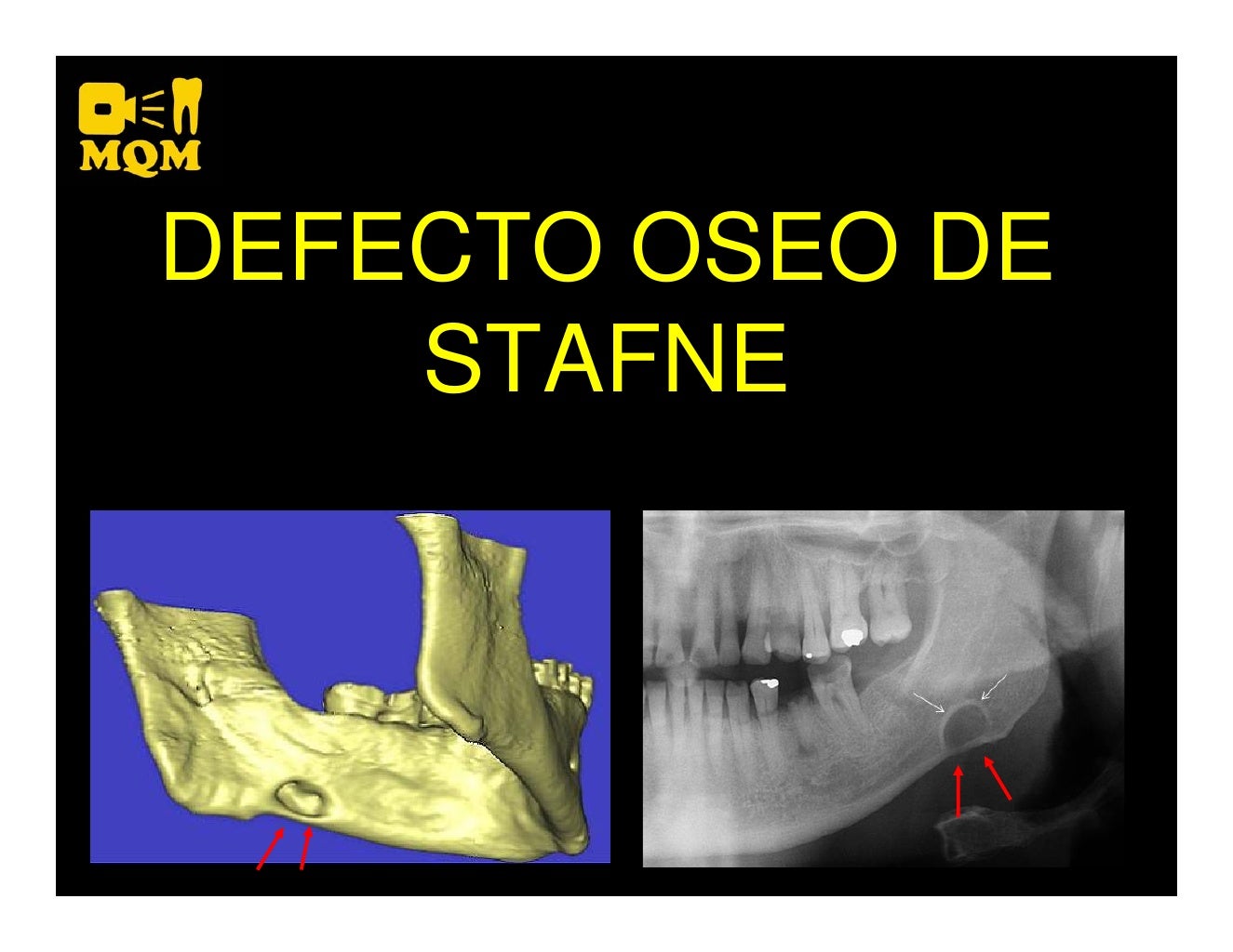 Defeito ósseo De Stafne - RETOEDU