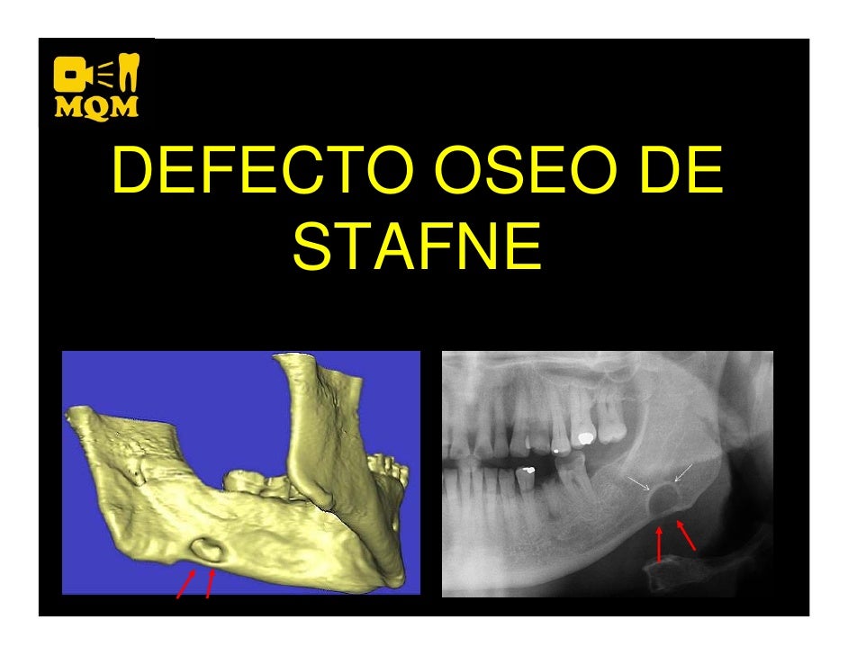 Defecto Oseo de Stafne